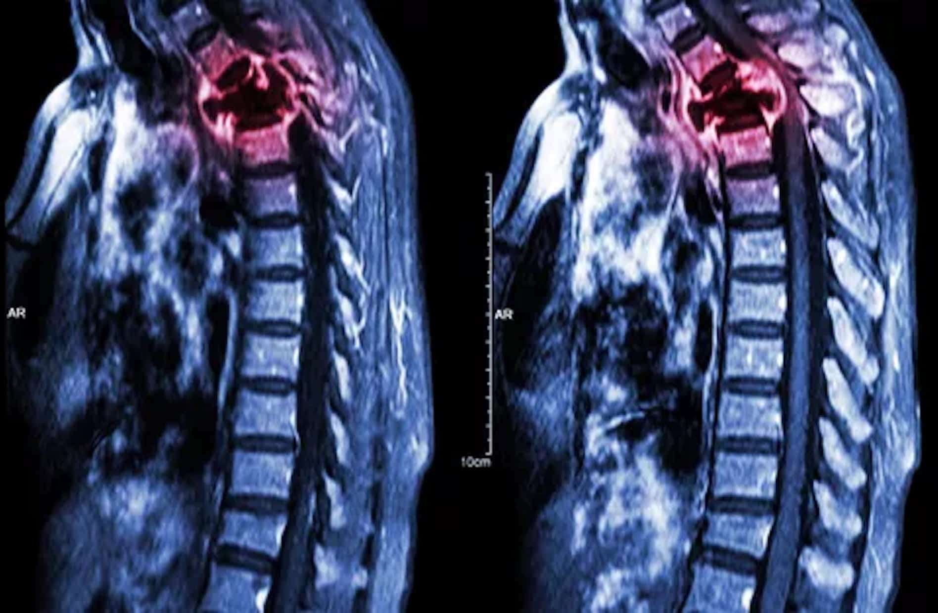 Bone Cancer in Irvine